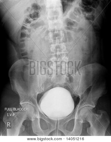 Xray Kub Intravenous Pyelogram Youtube